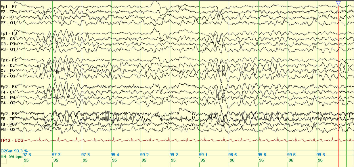 EPILEPSY WITH MYOCLONIC ATONIC SEIZURES EMAtS 